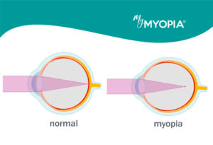 Frequently Asked Questions - MyMyopia