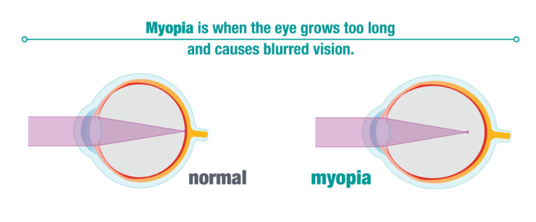 Myopia Resource Center - for Parents and Eye Care Professionals