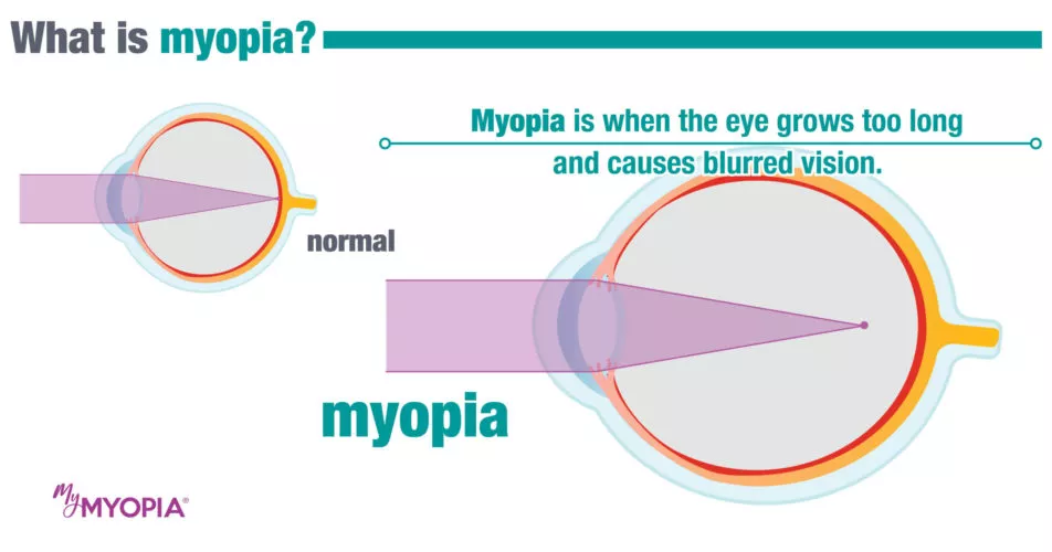 Myopia Resource Toolkit - Download the ZIP file and "How To" Guide