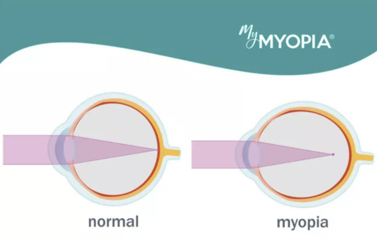 I just learned my child may be nearsighted (has myopia), tell me what I ...